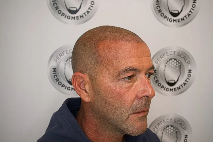 Scalp Micropigmentation FAQ's: All You Need To Know About SMP